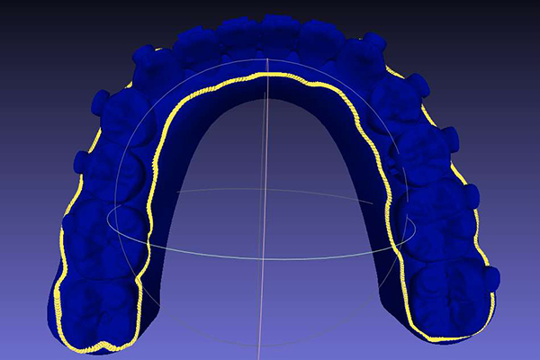 Automatic Trimming Machine for Clear Aligners | ConverSight Orthodontic ...